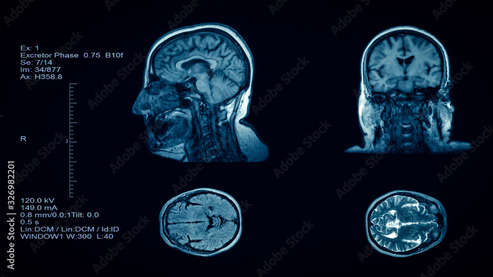 Foto de Head and brain computer tomography result visualization. Four ...