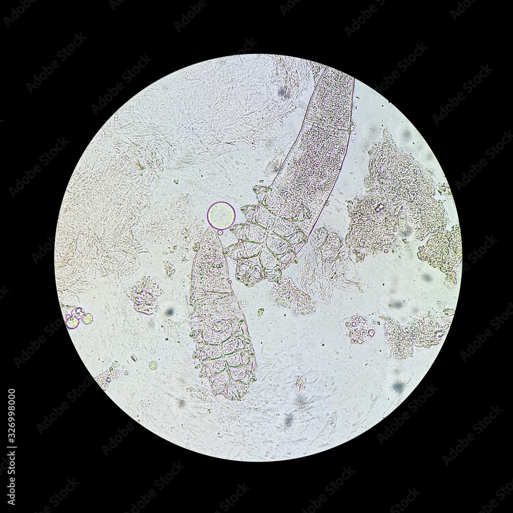 Demodex mite from a microscope view. The parasite causing a skin ...