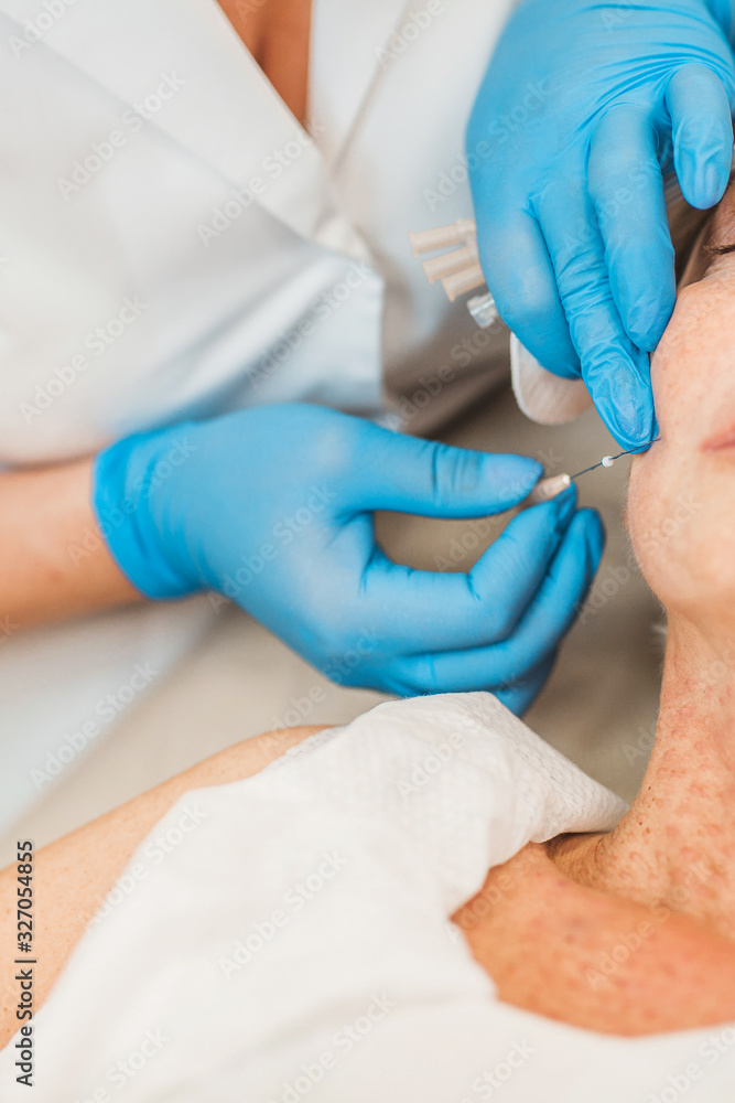 Thread lifting - a minimally invasive procedure for tightening skin of ...