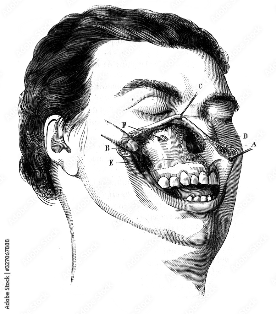 Anterior surface of the maxilla, discovered by the simple upper lip ...