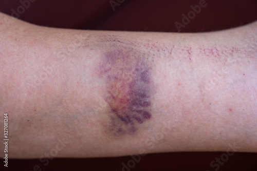 Skin disease on the body, viral skin disease Measles rash with ...