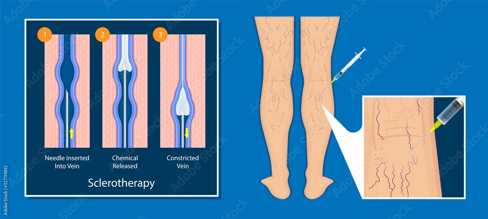 endovenous laser treatment CVD treat ELT legs inject EVLT varicose ...
