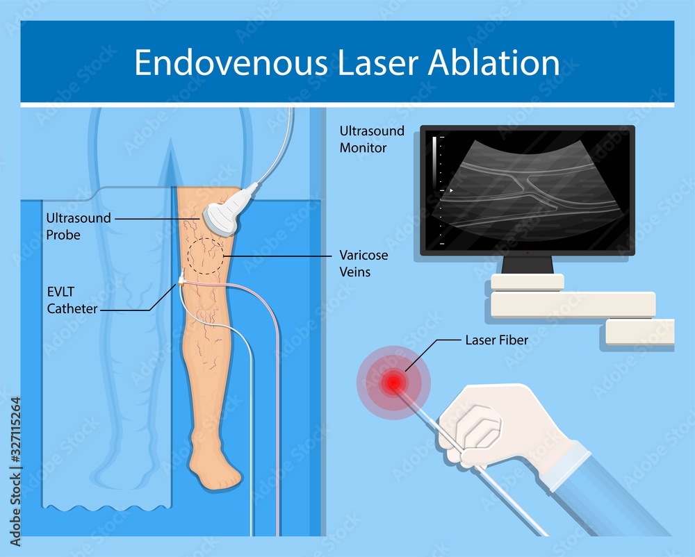 endovenous laser treatment CVD treat ELT legs inject EVLT varicose ...