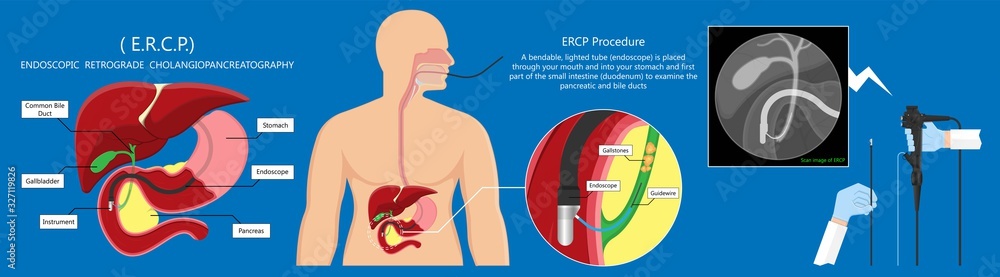 Photo & Art Print Endoscopic Retrograde Cholangiopancreatography ERCP ...