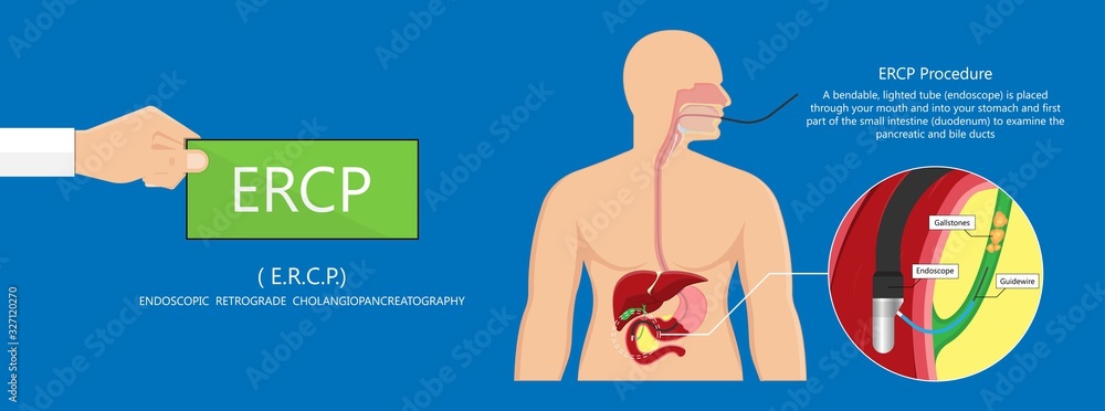 Endoscopic Retrograde Cholangiopancreatography ERCP diagnose treat ...
