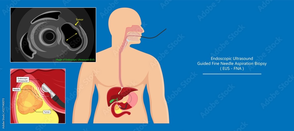 Fototapeta medical endoscopic ultrasound EUS cancer tumor diagnose FNA ...