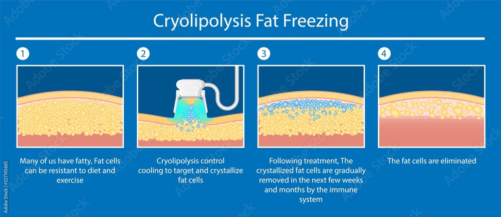 cryolipolysis fat freezing procedure cold treatment non invasive ...