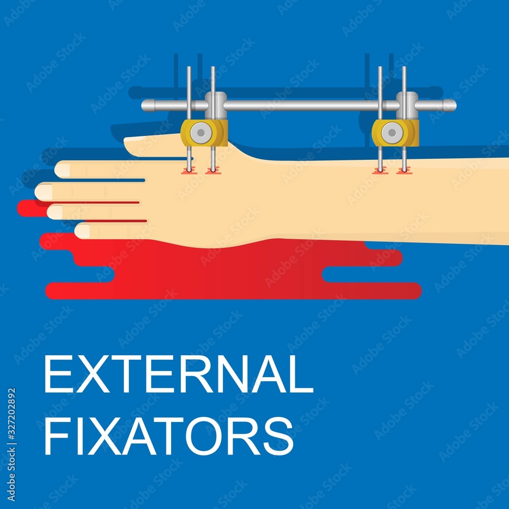 External Fixator treatment broken bone injury accident fracture ...