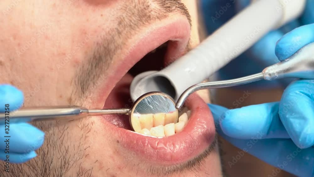 open mouth of a male client during a session in a dental office, close ...