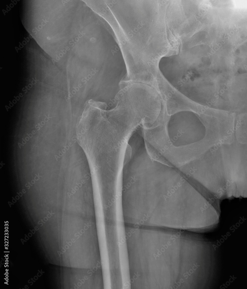 x- ray of the hip joint with coxarthrosis Stock Photo | Adobe Stock