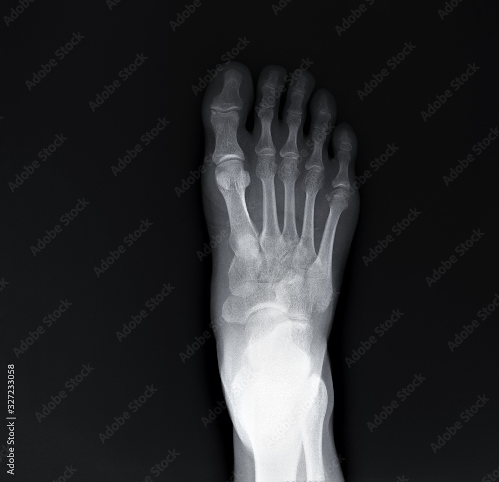 x-ray of the foot, diagnosis of fractures, arthritis, deforming ...