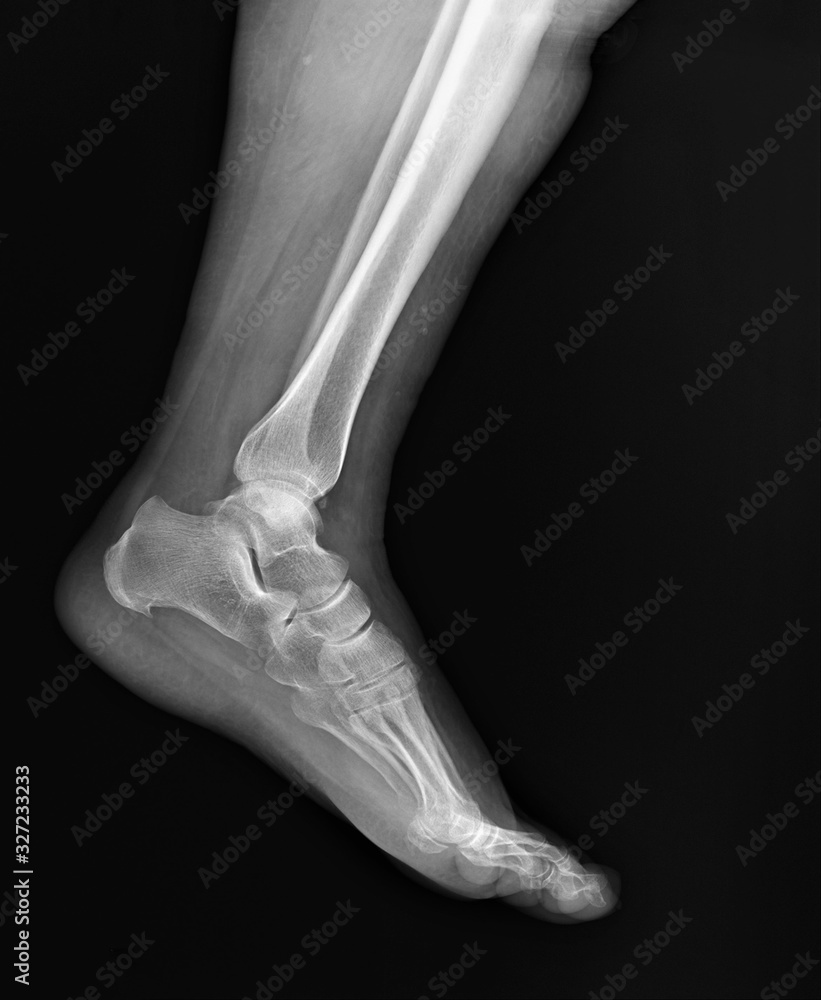 x- ray of the ankle joint in the lateral projection, arthritis ...
