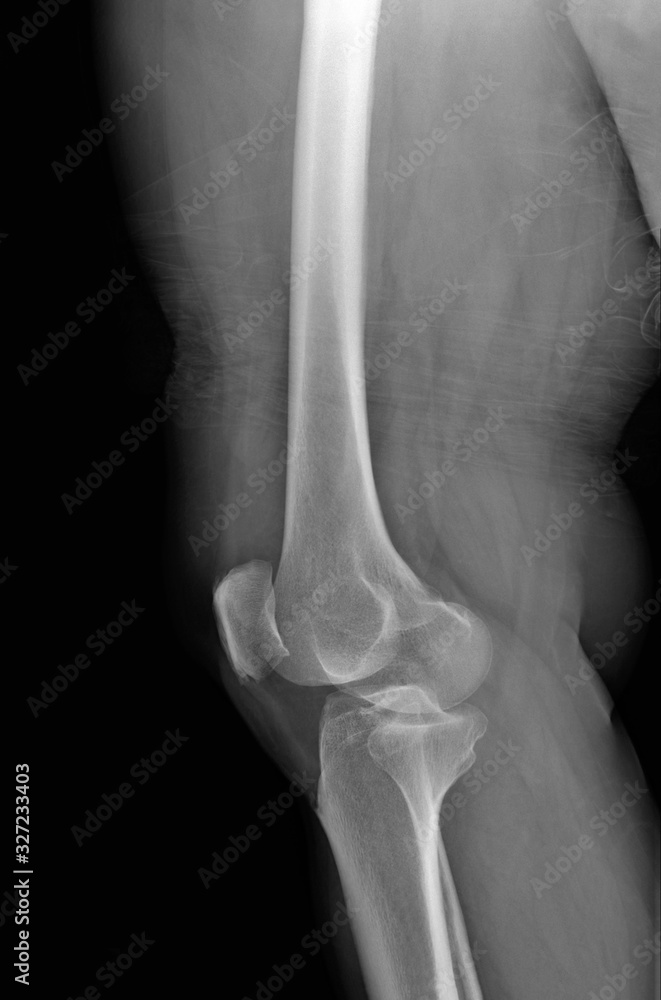 x-ray of the knee joint, diagnosis of arthrosis,arthritis Stock Photo ...