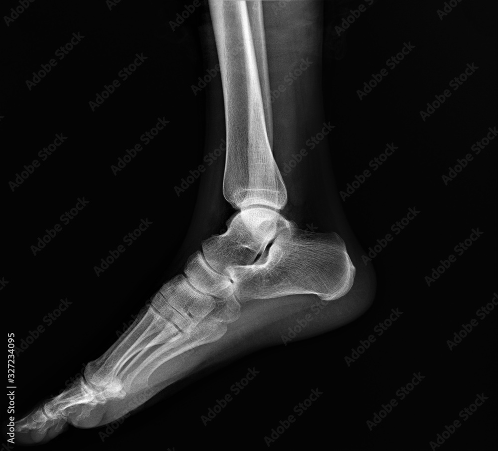 x- ray of the ankle joint in the lateral projection, arthritis ...