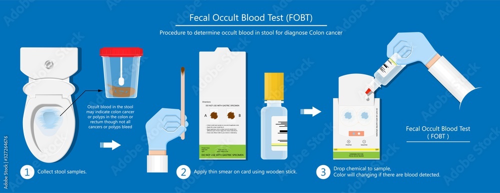 Fecal occult blood test FOBT lab stool sample bleeding screen risk ...