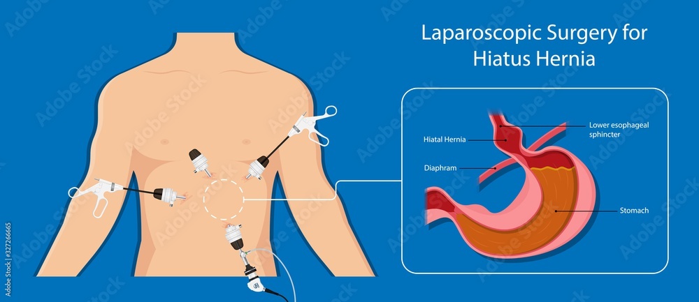 Reflux Hiatus Hernia Gastrooesophageal Reflux Disease
