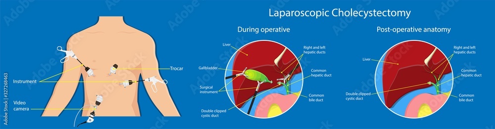 Gallstones cholecystectomy gallbladder removal surgery ultrasound ...