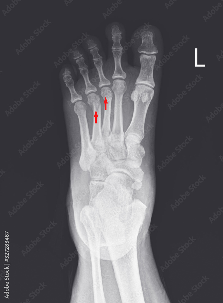 X-ray foot and ankle showing Metatarsal fractures . Stock Photo | Adobe ...
