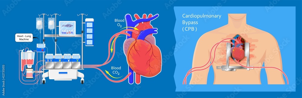 Cardiopulmonary bypass heart lung machine coronary oxygenator ...