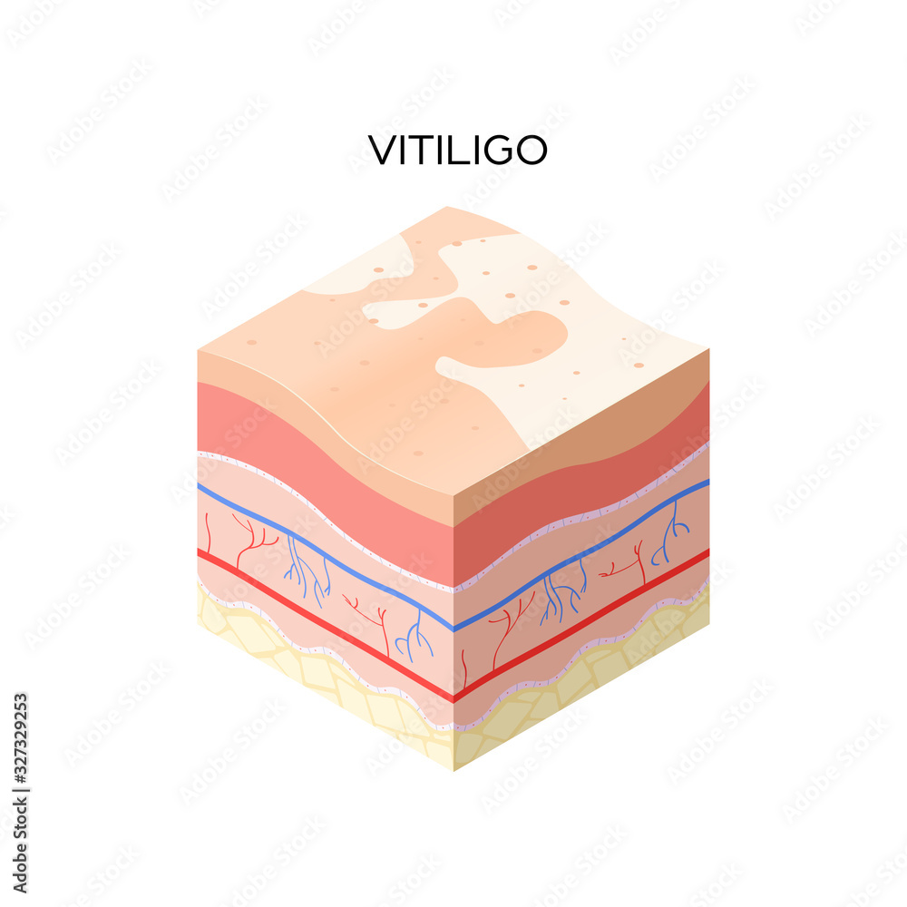 vitiligo skin cross-section of human skin layers structure skincare ...