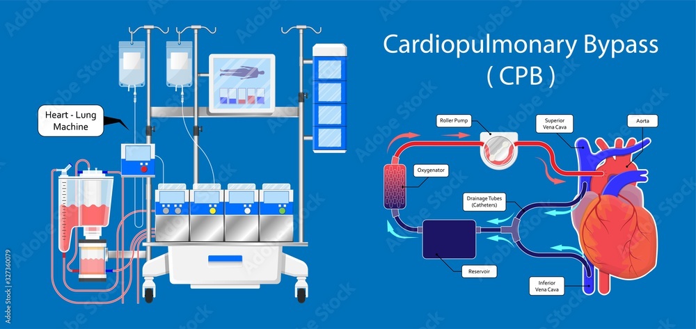 Cardiopulmonary bypass heart lung machine coronary oxygenator ...