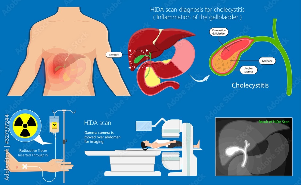 HIDA scan diagnosis treat liver scintigraphy inject cells scanner ...