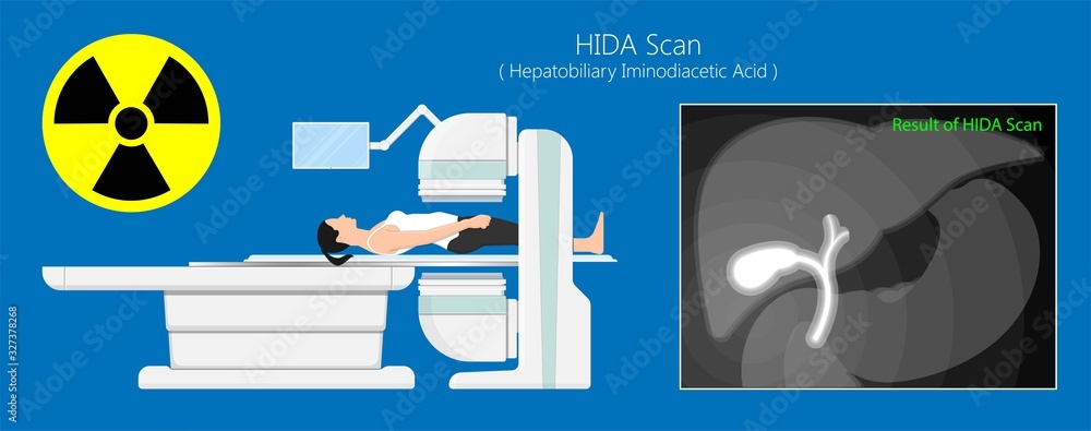 HIDA scan diagnosis treat liver scintigraphy inject cells scanner ...