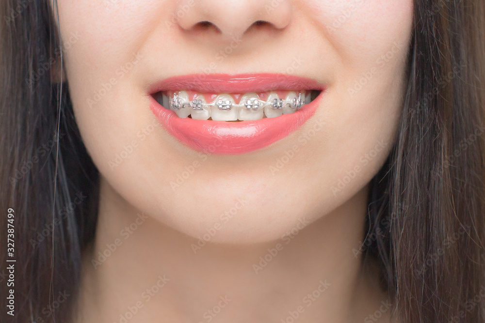 Young woman smile with dental braces. Brackets on the teeth after ...