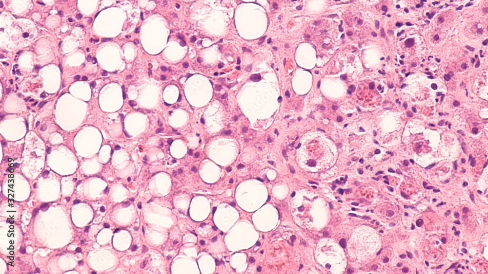 Photomicrograph of a liver core biopsy showing alcoholic liver disease ...