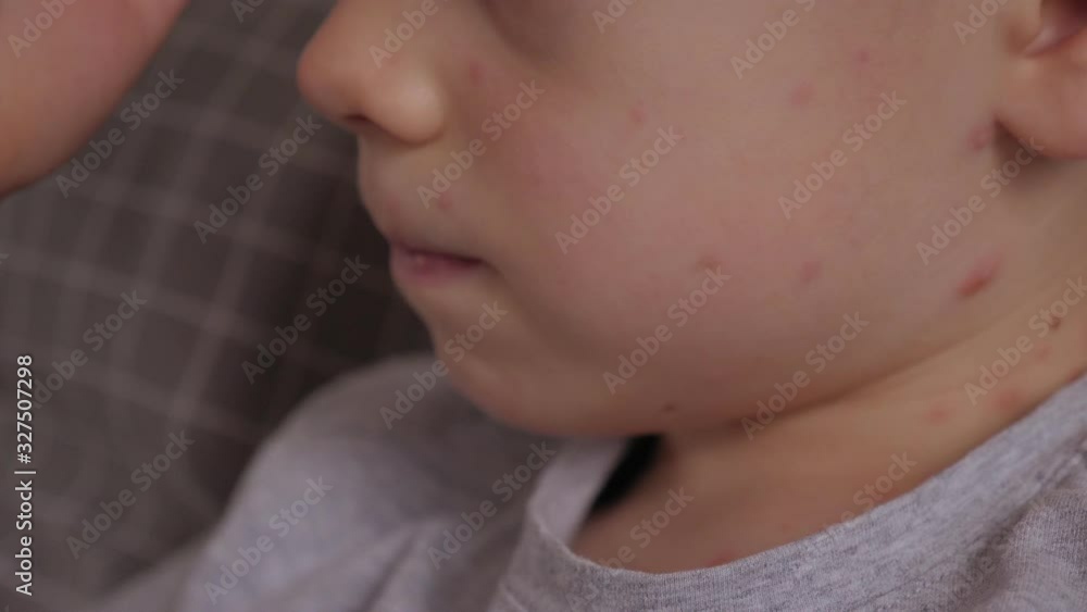 Close-up of a very large chicken pox blister on the neck of a small ...
