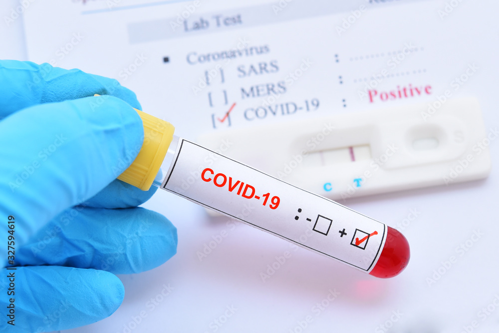 Positive test result by using rapid test device for COVID-19, novel ...