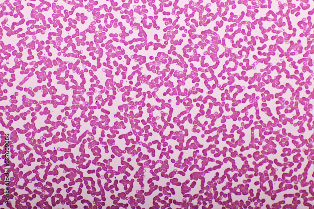 Red blood cells in blood smear, Wright-Giemsa stain, analyze by ...