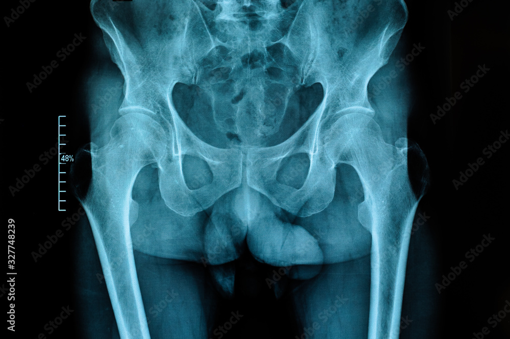 X Ray Of The Hip Joints Of An Adult Male With Osteoarthritis Selective 1885