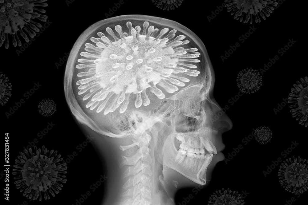 X-ray of a skull with COVID-19 instead of the brain Stock Illustration ...