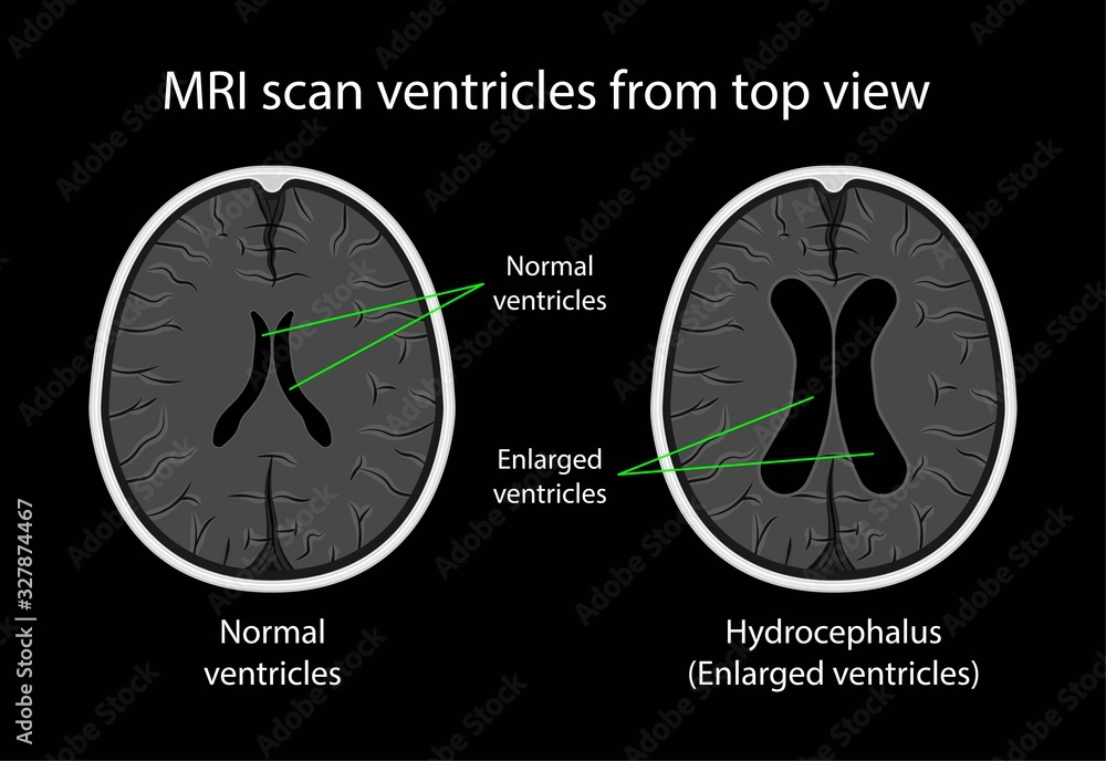 Hydrocephalus brain cerebrospinal fluid (CSF) drain head Stock Vector ...