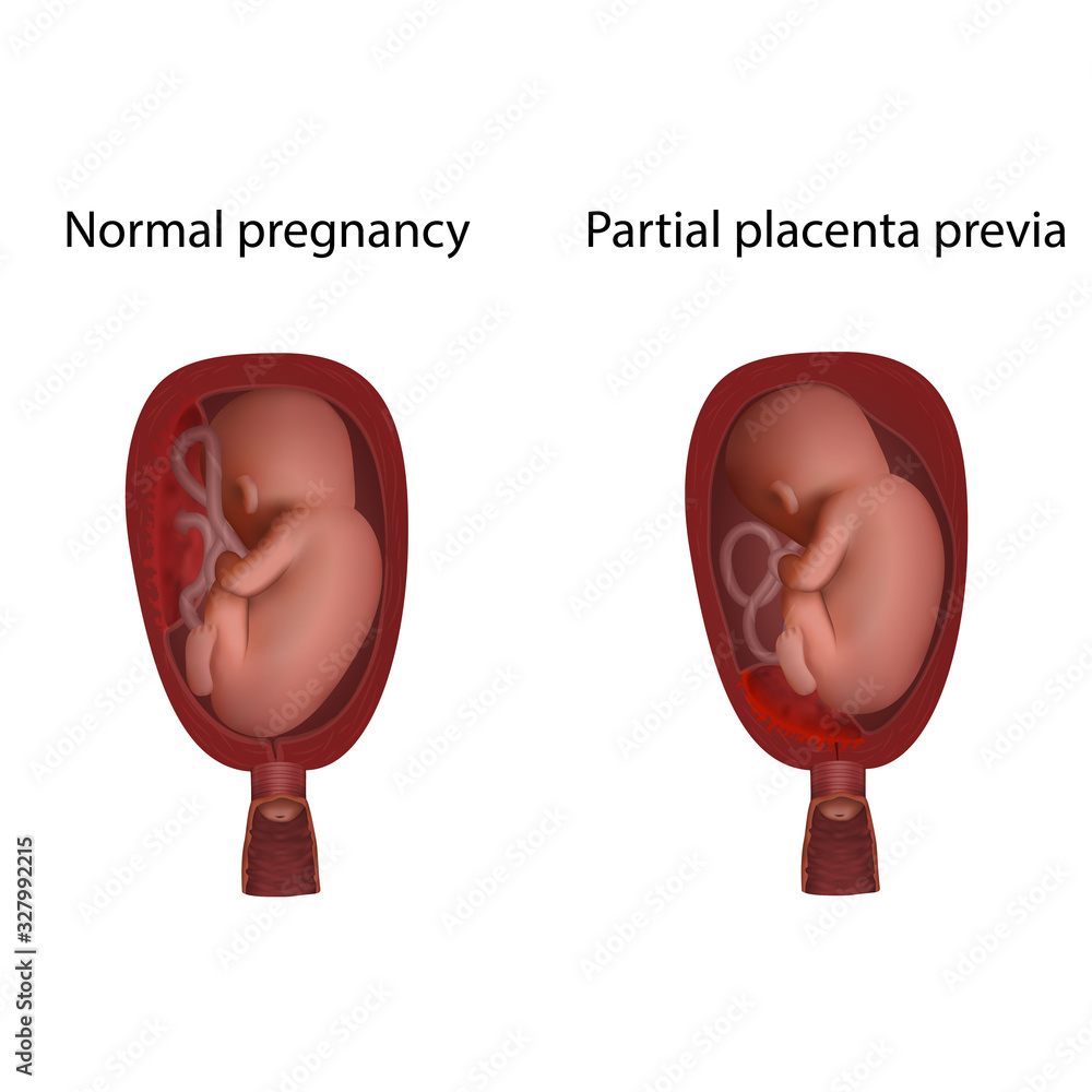 Normal and partial placenta previa. Fetus in uterus, womb, placenta ...