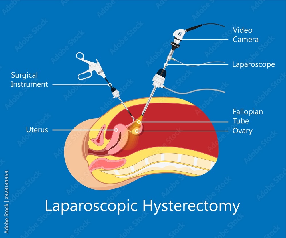 laparoscopic hysterectomy medical surgical treat cervix ovary subtotal ...