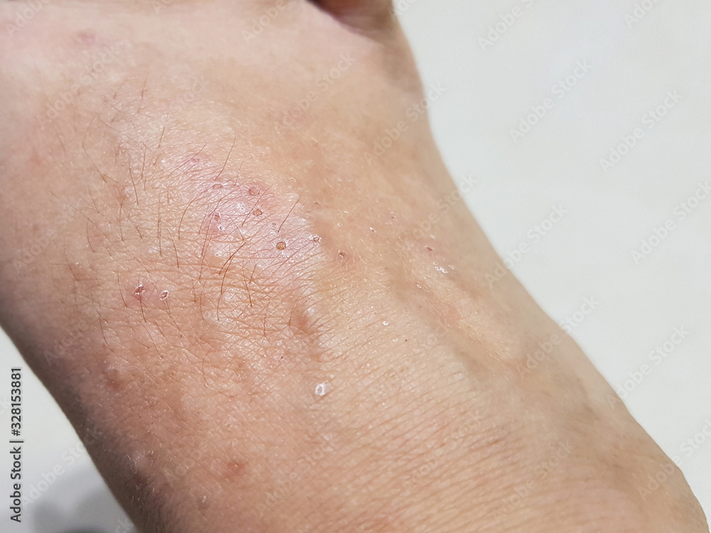 Wound inflammation at the foot from scratching at the itchy position ...