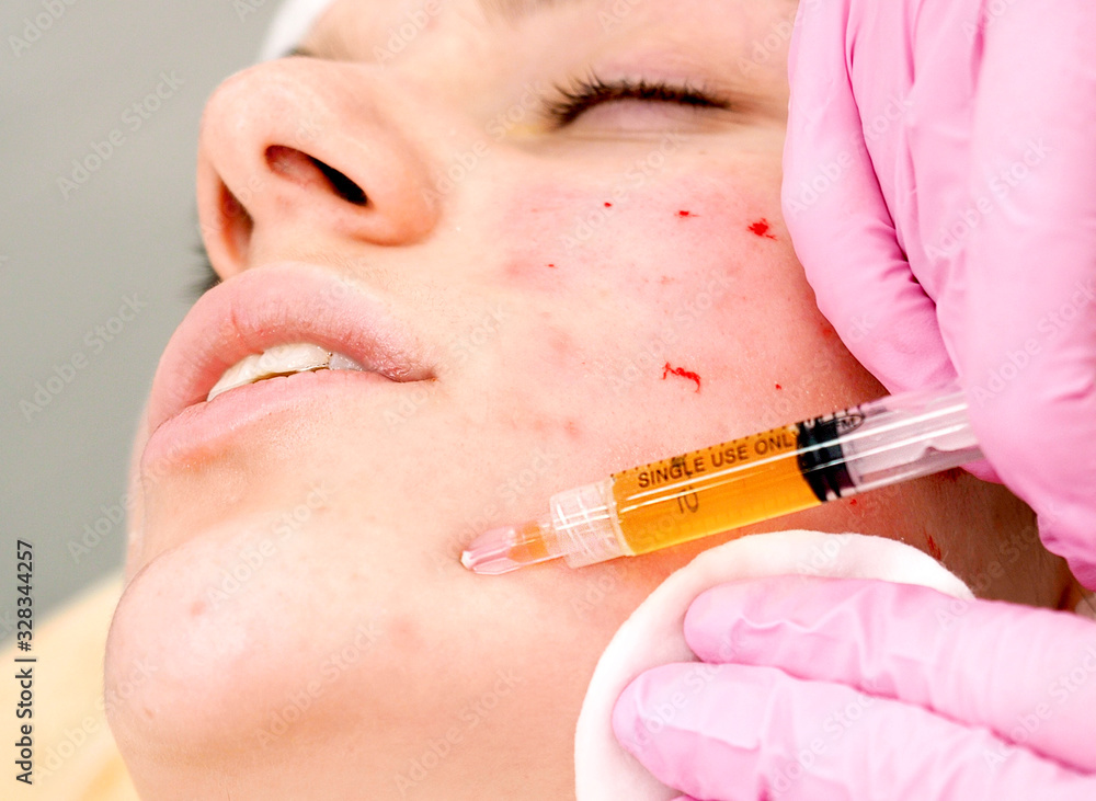 plasmolifting injection procedure. plasma injection into the skin of ...