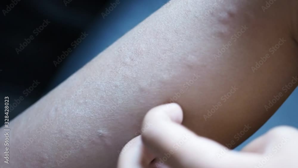 Children with dermatitis, Asian boy scratching skin of itchy and red ...