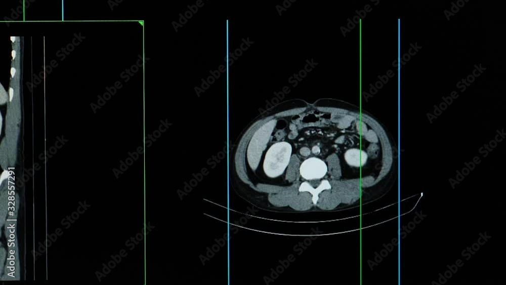 CT scan or computer tomography of a whole abdomen of a patient with ...