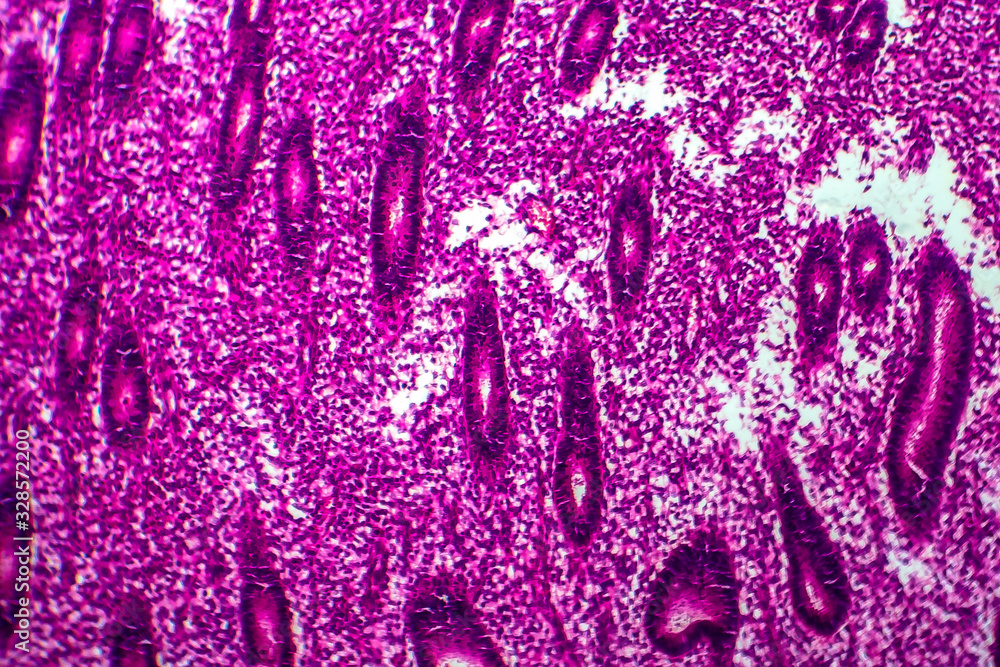 Endometrial hyperplasia, light micrograph, photo under microscope Stock ...
