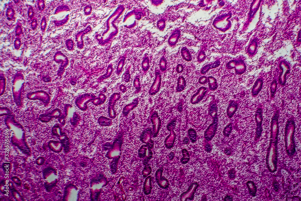 Foto de Endometrial hyperplasia, light micrograph, photo under ...