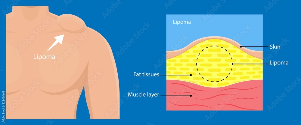 Lipoma disease tissue fatty grows body skin soft hurt pain madelung ...
