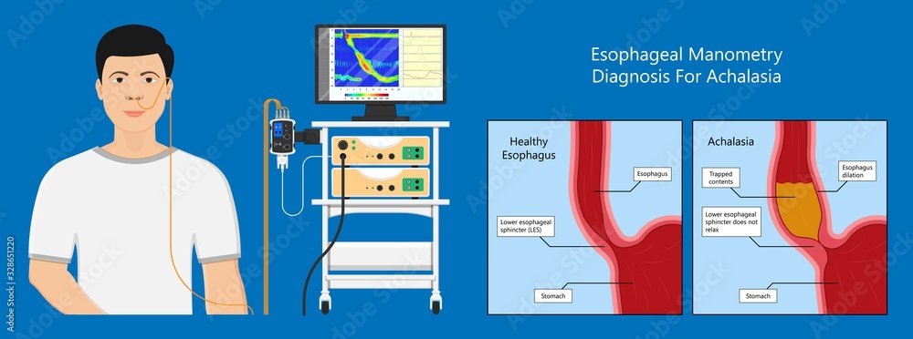 Achalasia High Resolution Manometry