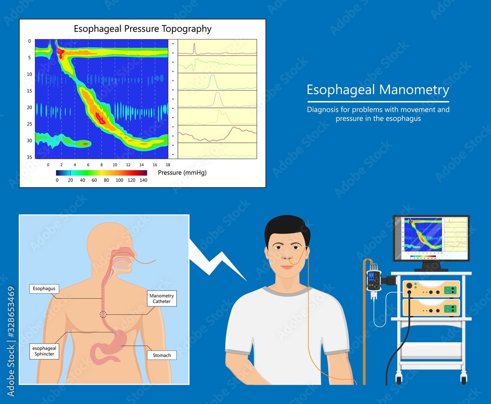 Esophageal manometry test esophageal diagnose food high resolution ...