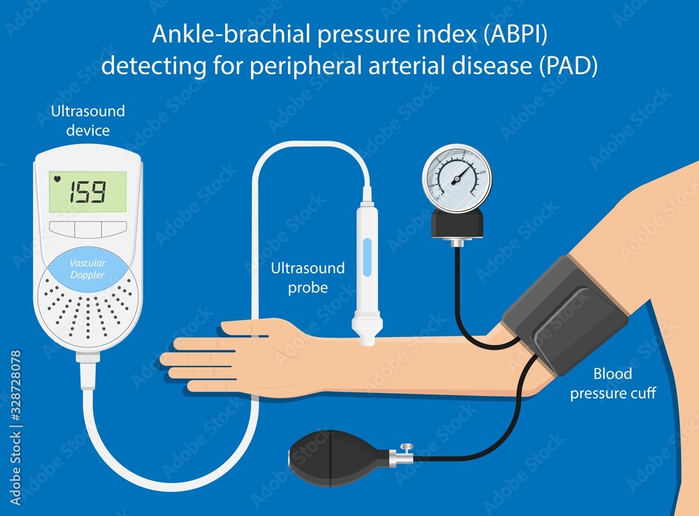 Peripheral artery disease ankle brachial index ABI test limb ischemia ...