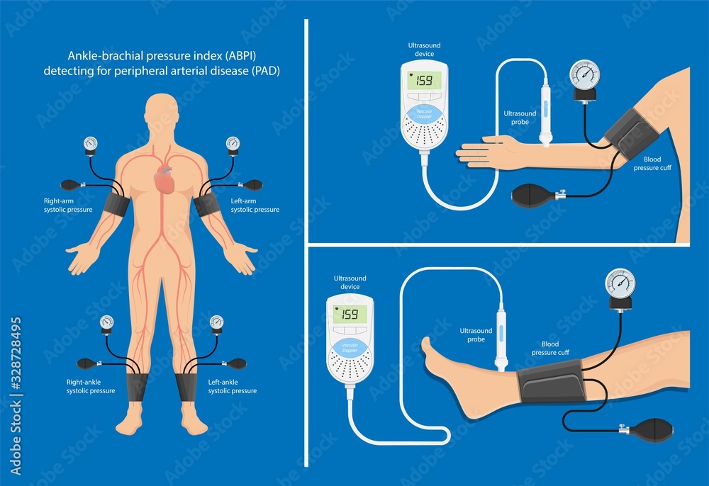 Peripheral artery disease ankle brachial index ABI test limb ischemia ...