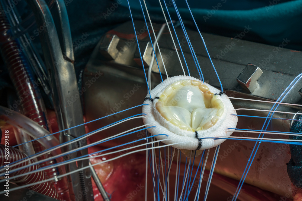 Heart valve prosthesis. Close up image of aortic valve implant during ...