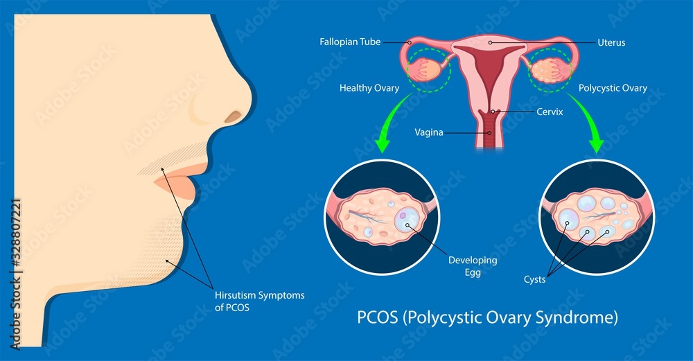 polycystic ovary syndrome PCOS hormonal diagnose diagnostic exam ...